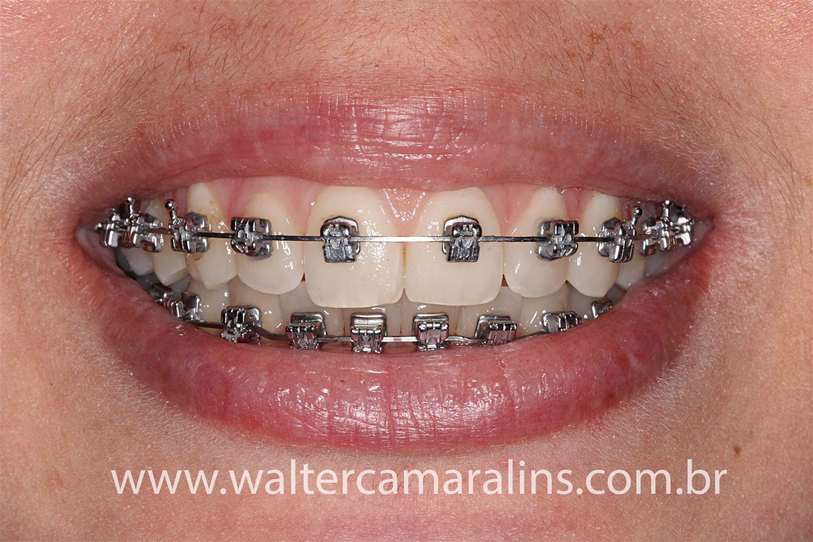 Autoligados - Ortodontista Walter Camara Lins