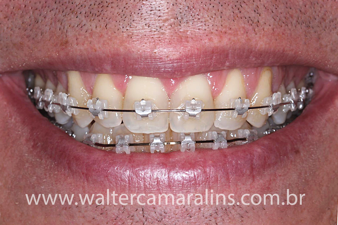 Autoligados Estéticos - Ortodontista Walter Camara Lins